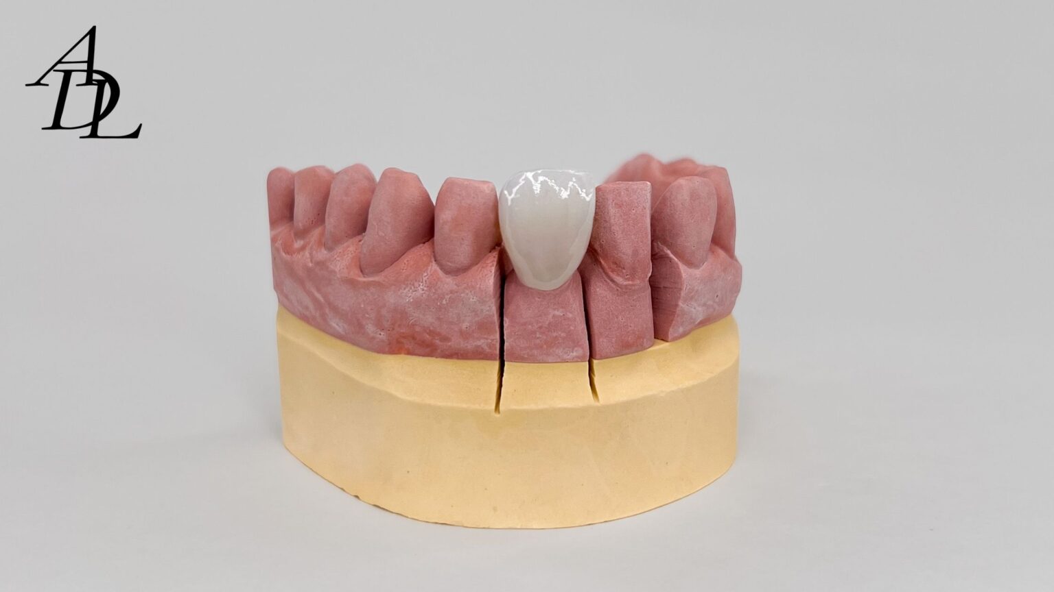 PFM Crowns versus Zirconia Crown: Understanding Crowns - Associated ...
