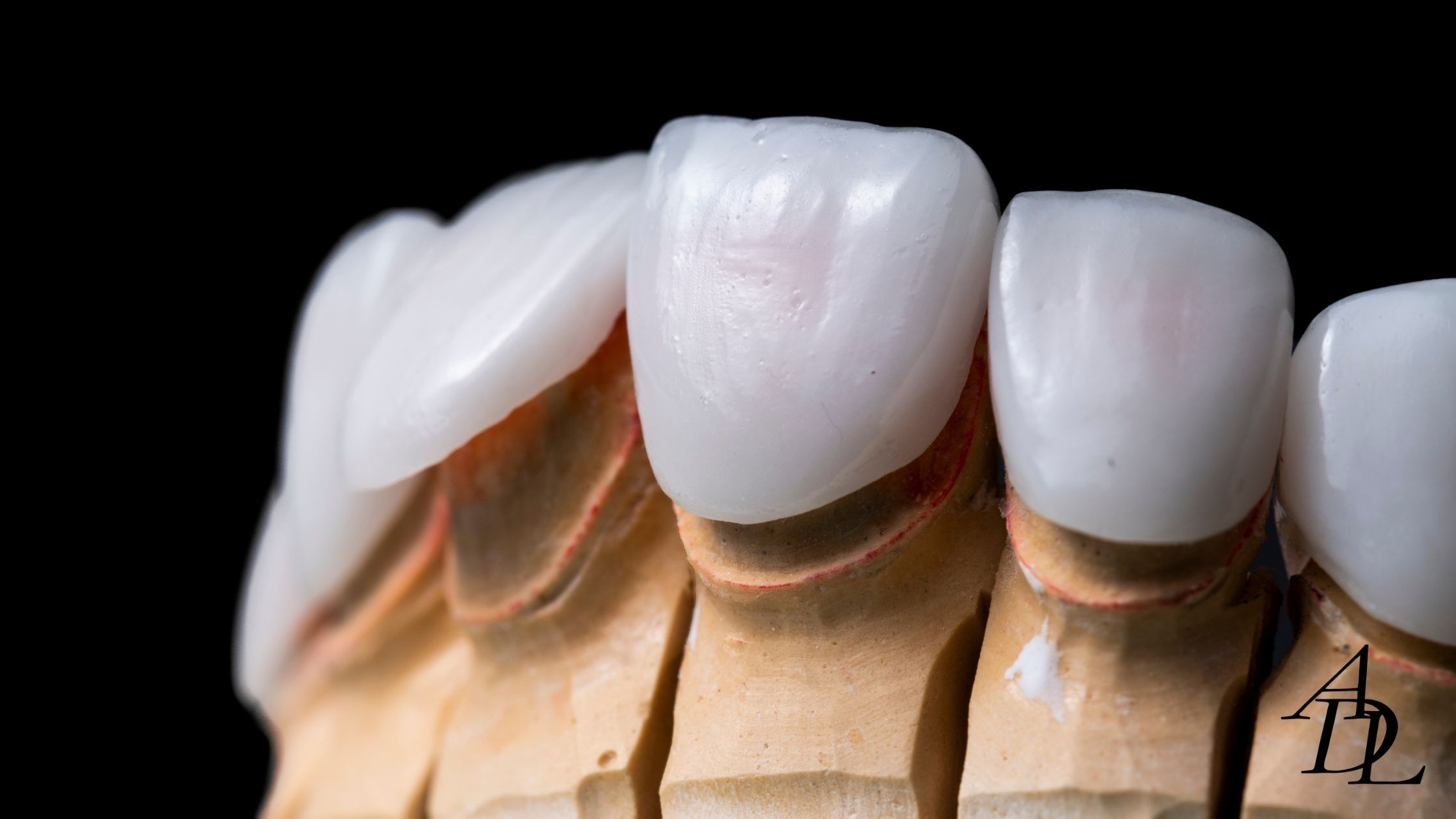 Margin Elevation vs. Crown Lengthening: A Lab Guide - Associated Dental Lab